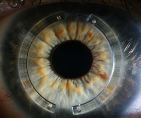 Anneaux cornéens | Eye Care Center Hydra